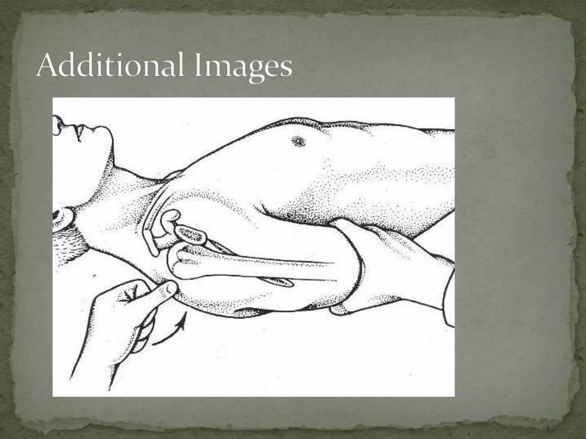 Posterior Shoulder Dislocation | PPTX