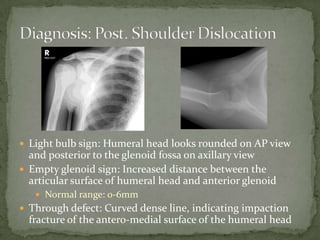 Posterior Shoulder Dislocation | PPTX