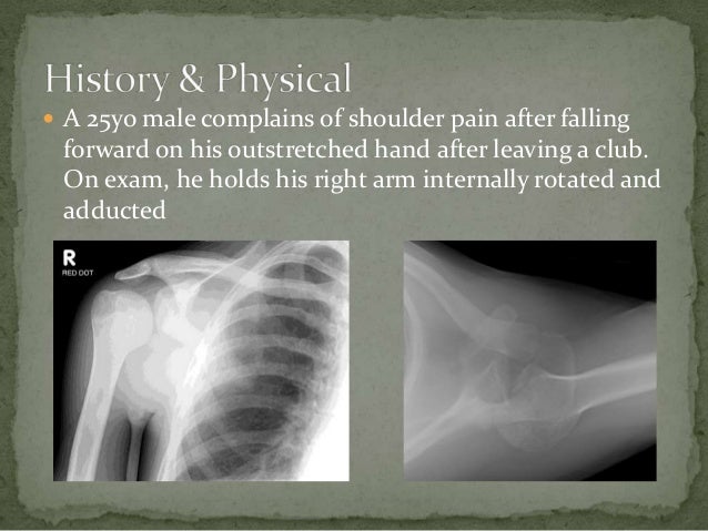 Posterior Shoulder Dislocation