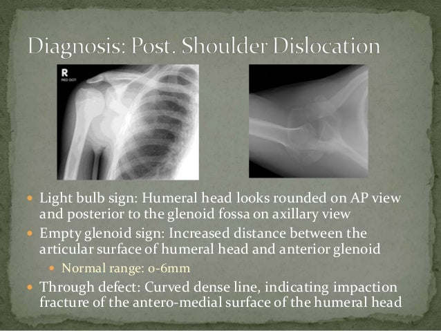 Posterior Shoulder Dislocation
