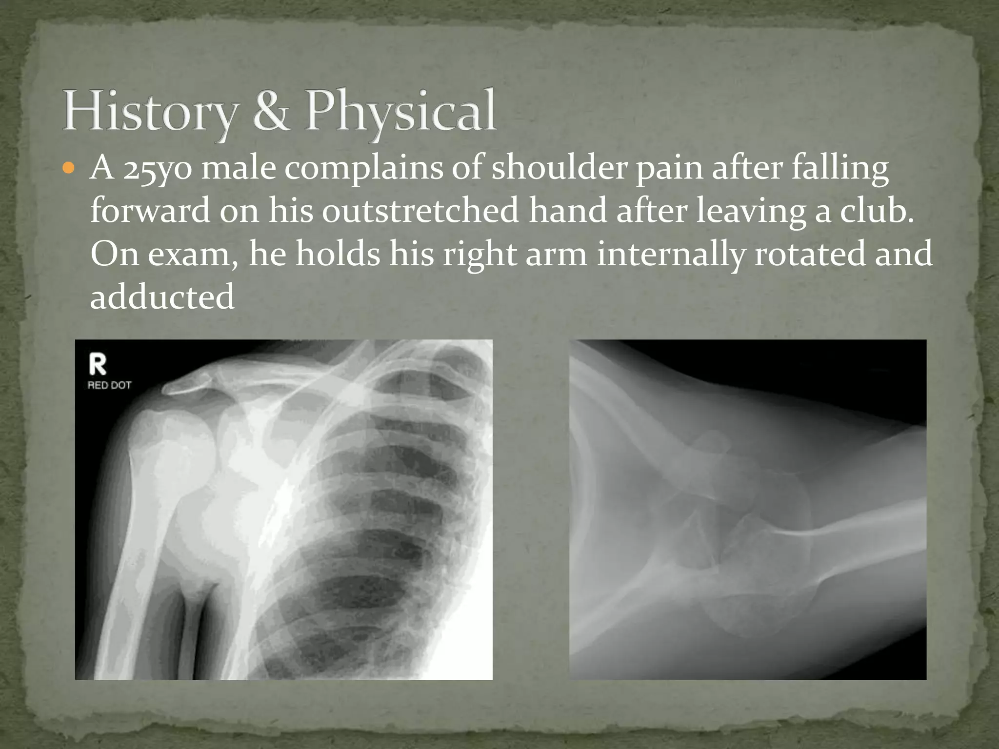Posterior Shoulder Dislocation | PPTX