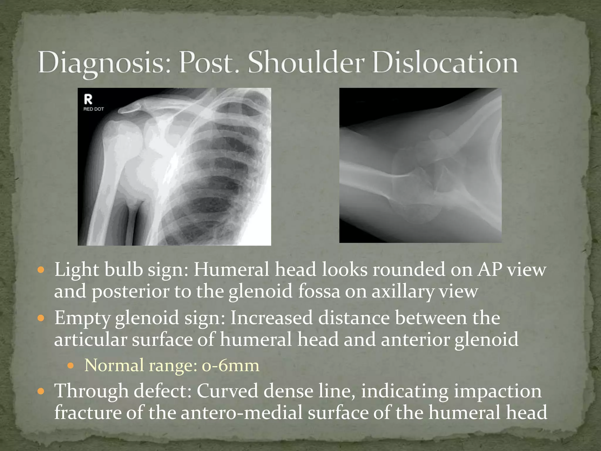 Posterior Shoulder Dislocation | PPTX