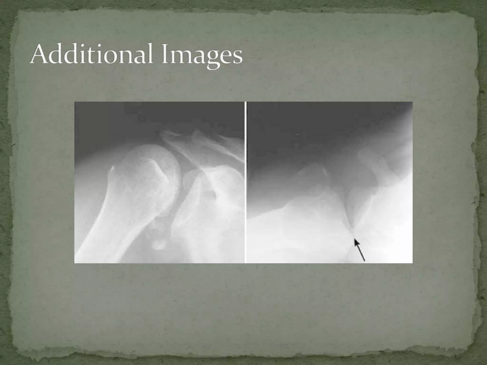 Posterior Shoulder Dislocation | PPTX