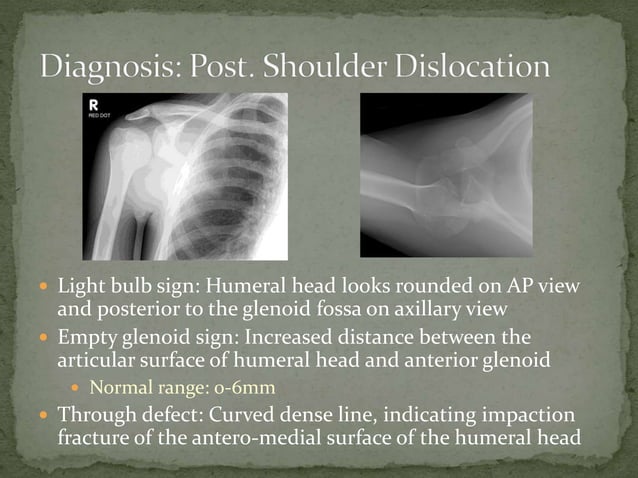 Posterior Shoulder Dislocation | PPT