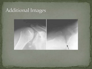 Posterior Shoulder Dislocation | PPT