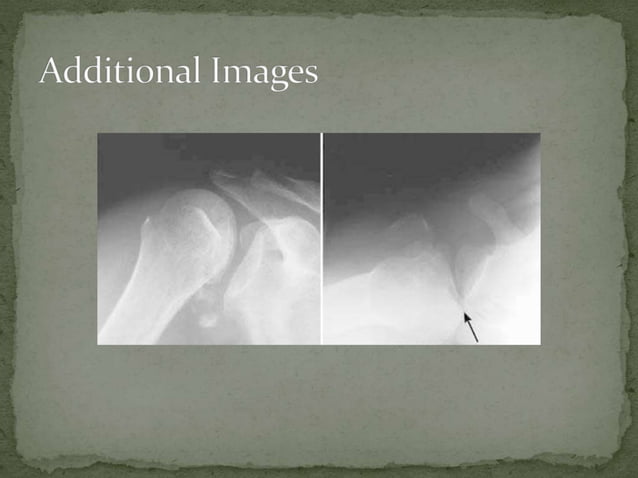 Posterior Shoulder Dislocation | PPT