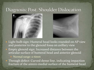 Posterior Shoulder Dislocation | PPT
