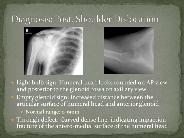 Posterior Shoulder Dislocation