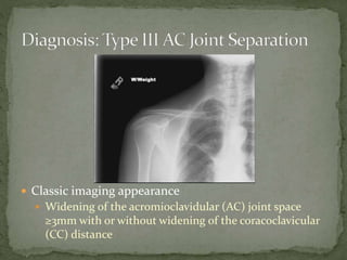 AC Joint Separation | PPT