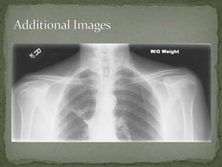 AC Joint Separation | PPT