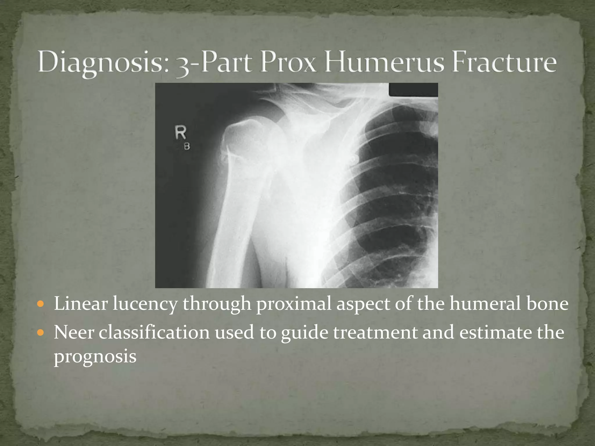 Proximal Humerus Fracture | PPTX