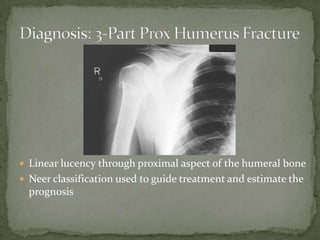 Proximal Humerus Fracture | PPTX | Death, Injury, or Military Conflict ...