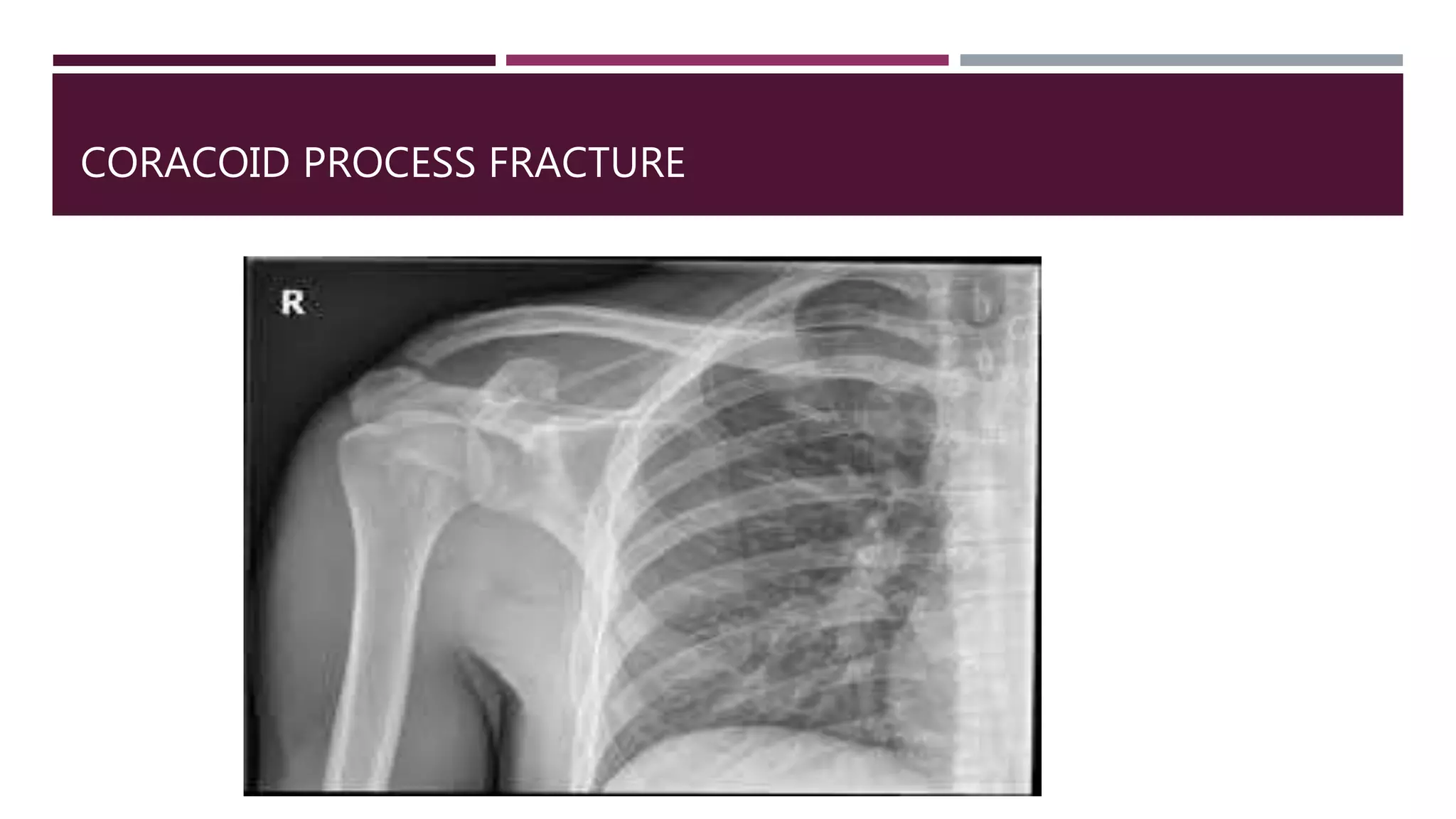 SHOULDER POSITIONING - ANAND GURMAITA ( BSc. RADIOLOGY ) | PPTX