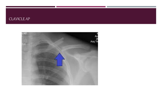 SHOULDER POSITIONING - ANAND GURMAITA ( BSc. RADIOLOGY ) | PPTX | Death ...