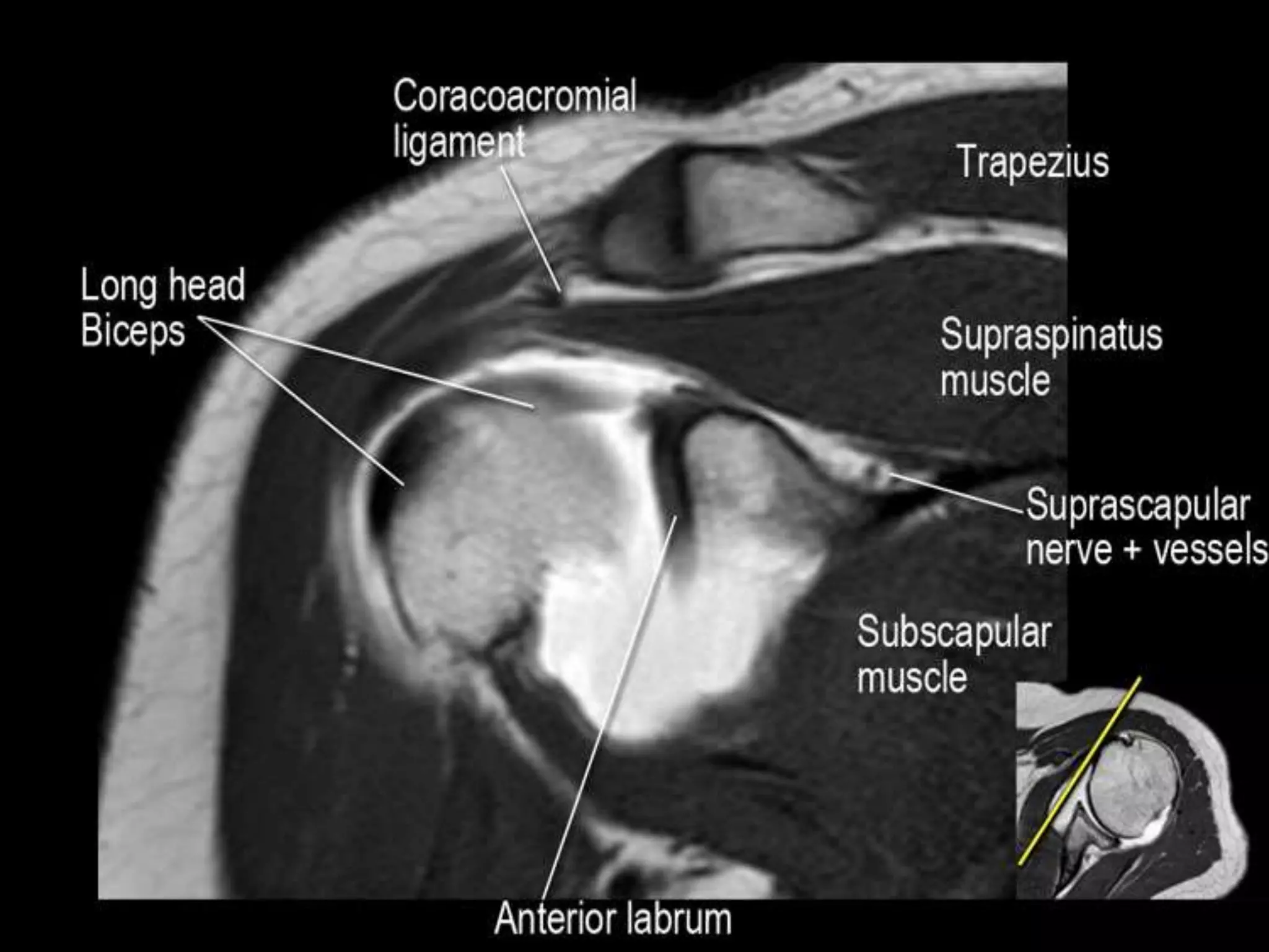 MRI of Shoulder anatomy | PPTX
