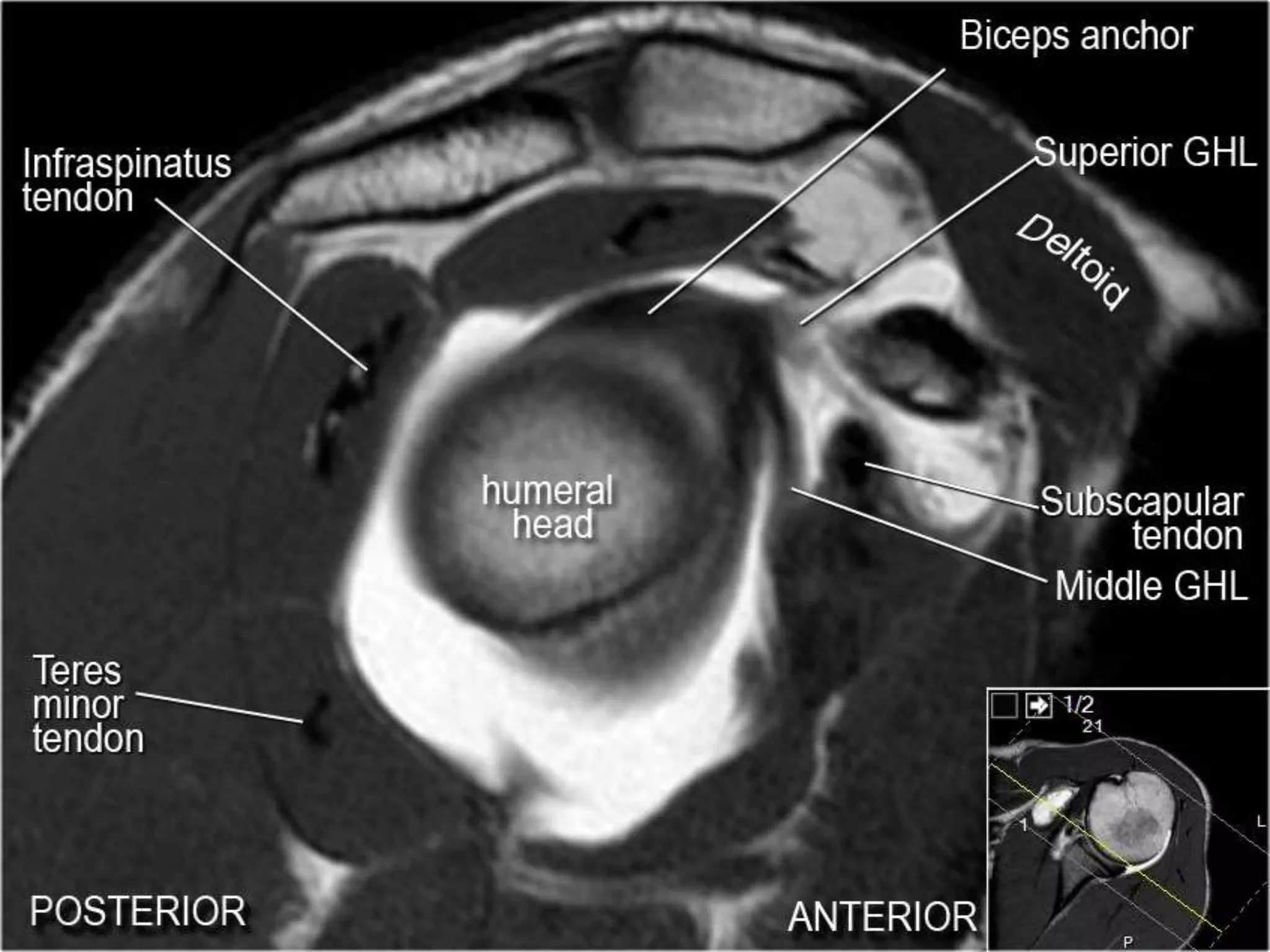 MRI of Shoulder anatomy | PPTX