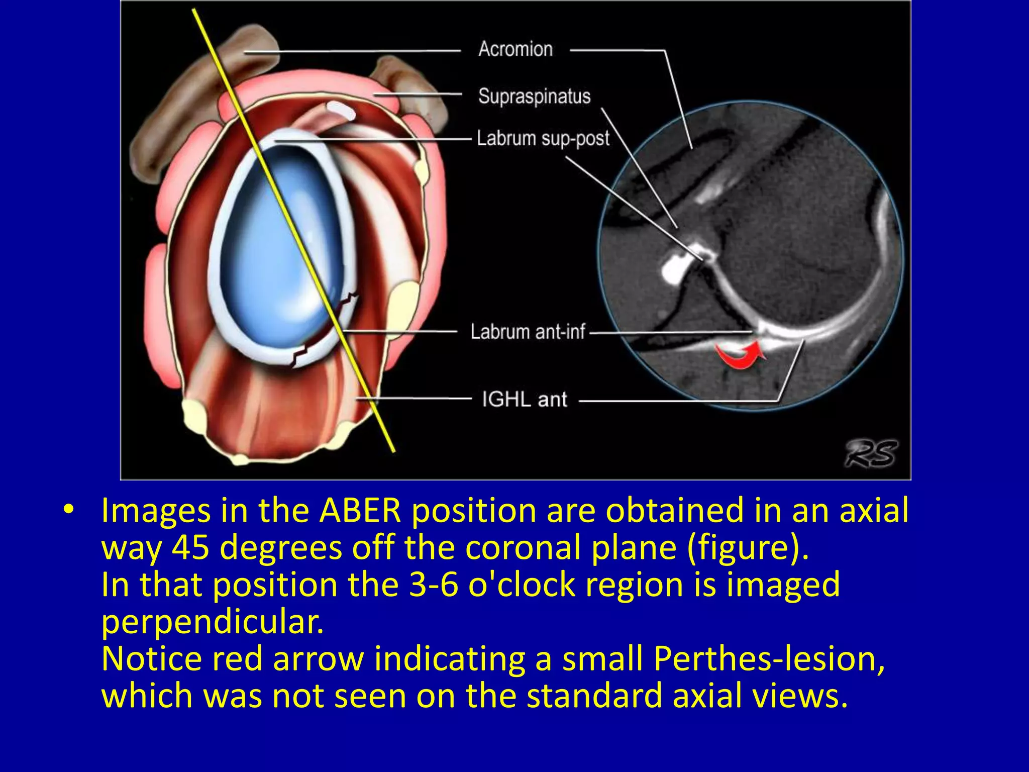 MRI of Shoulder anatomy | PPTX
