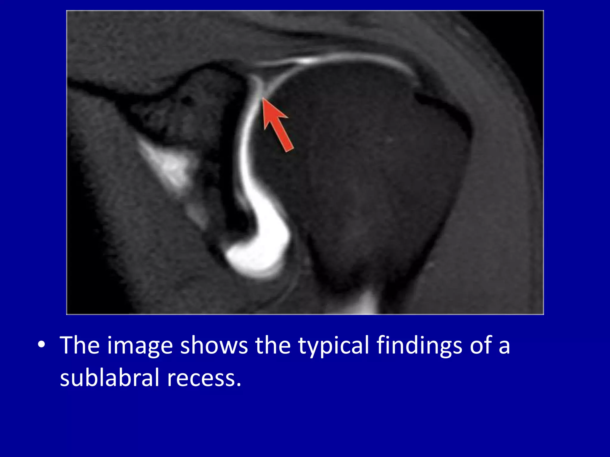 MRI of Shoulder anatomy | PPTX