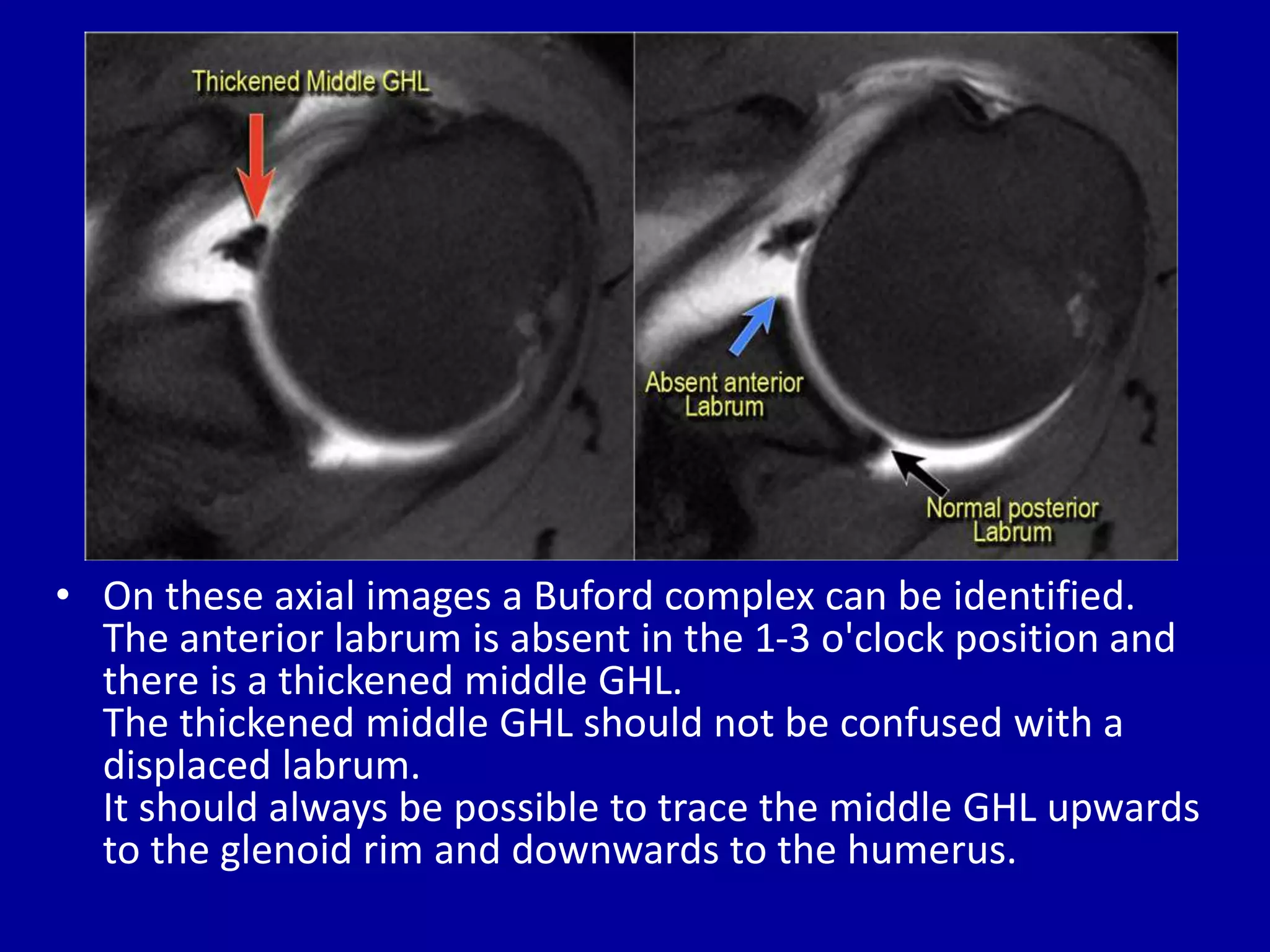 MRI of Shoulder anatomy | PPTX