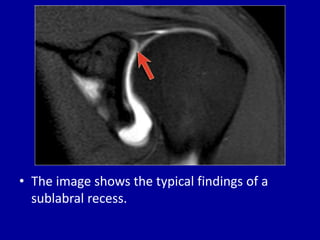 MRI of Shoulder anatomy | PPTX