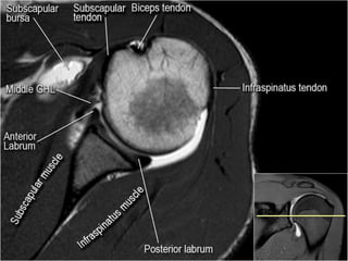 Shoulder Joint Anatomy Mri