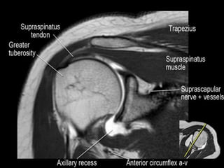 Shoulder Joint Anatomy Mri