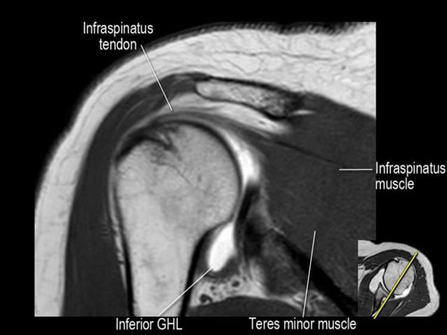 MRI of Shoulder anatomy