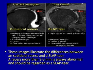 MRI of Shoulder anatomy | PPT