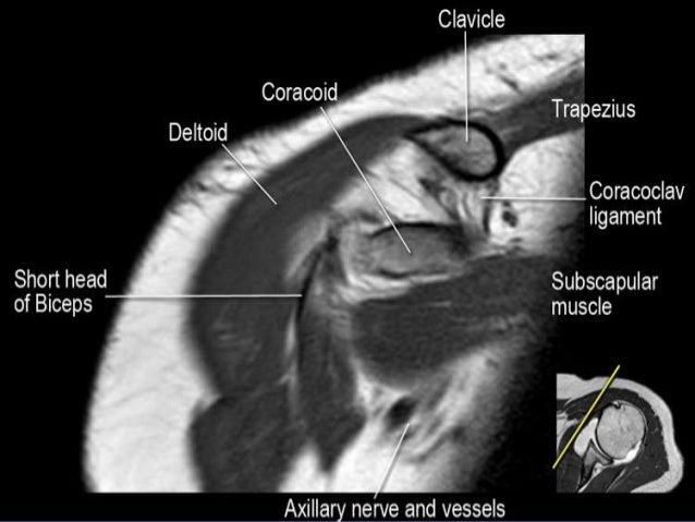 MRI of Shoulder anatomy