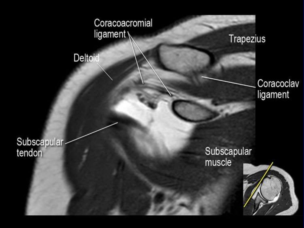MRI of Shoulder anatomy