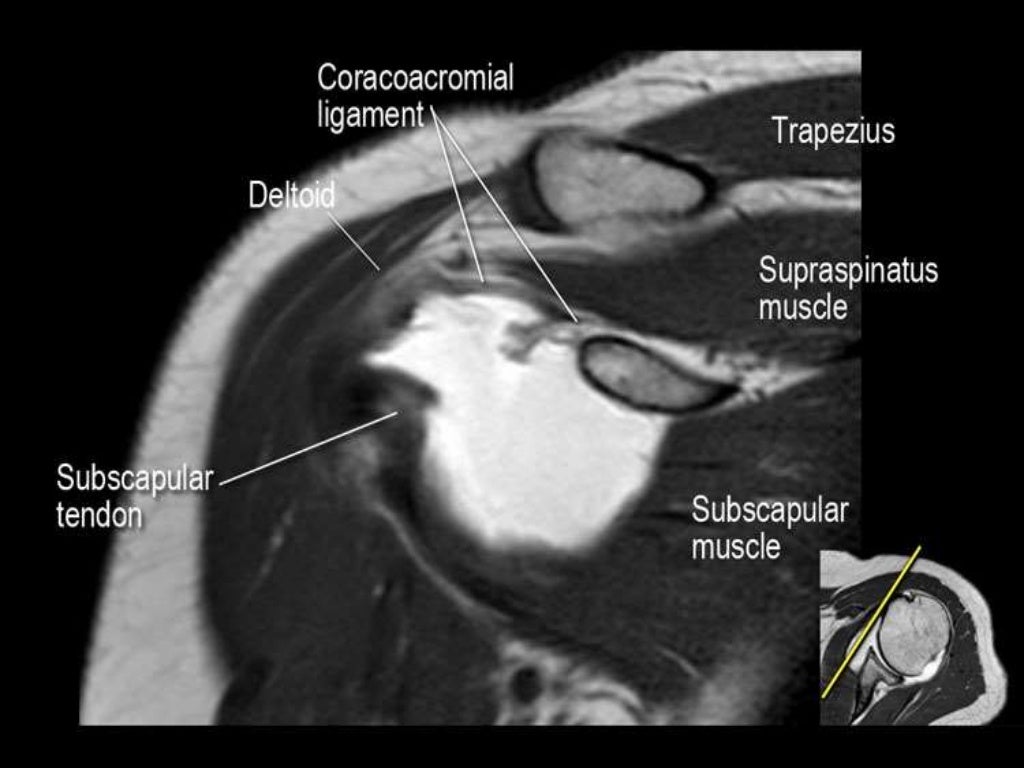 MRI of Shoulder anatomy