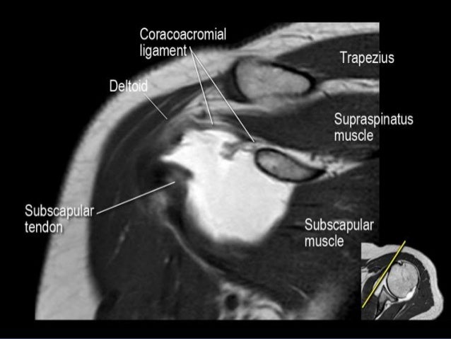 MRI of Shoulder anatomy