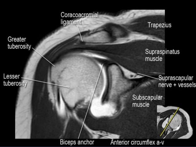 MRI of Shoulder anatomy