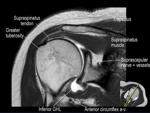 MRI of Shoulder anatomy