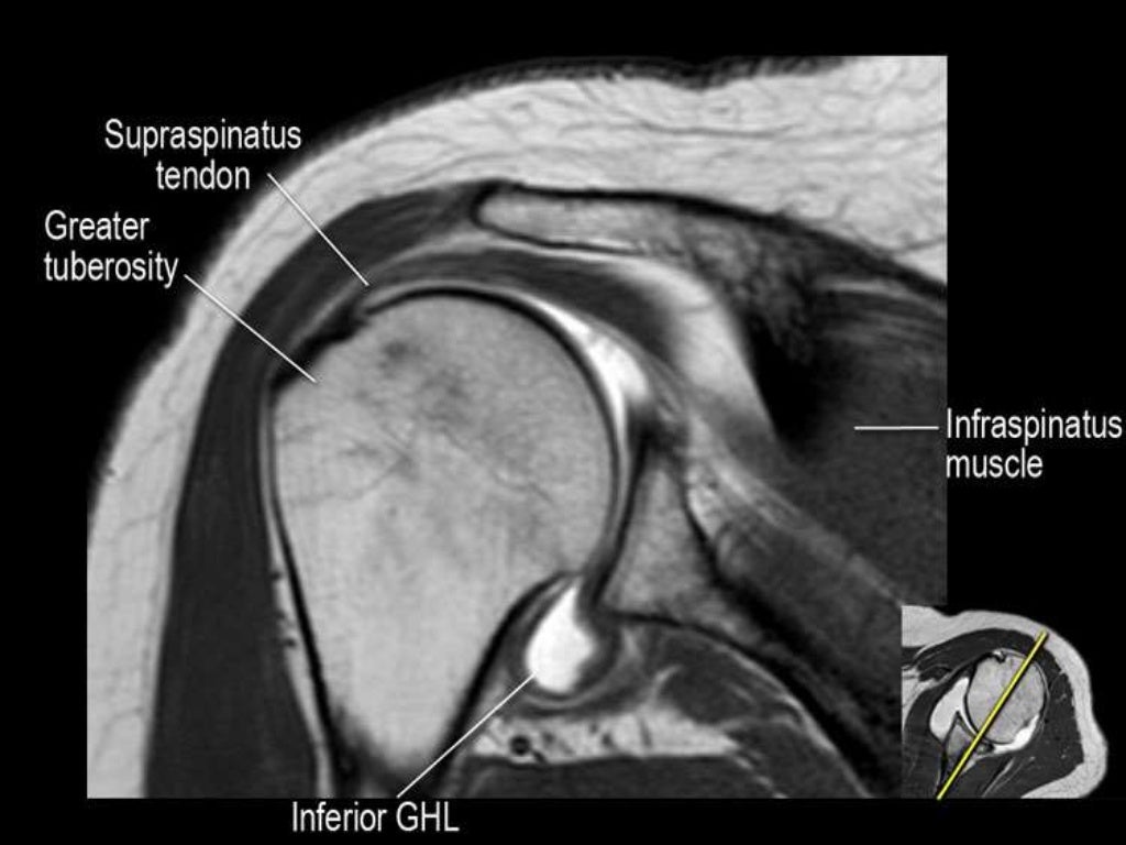 MRI of Shoulder anatomy