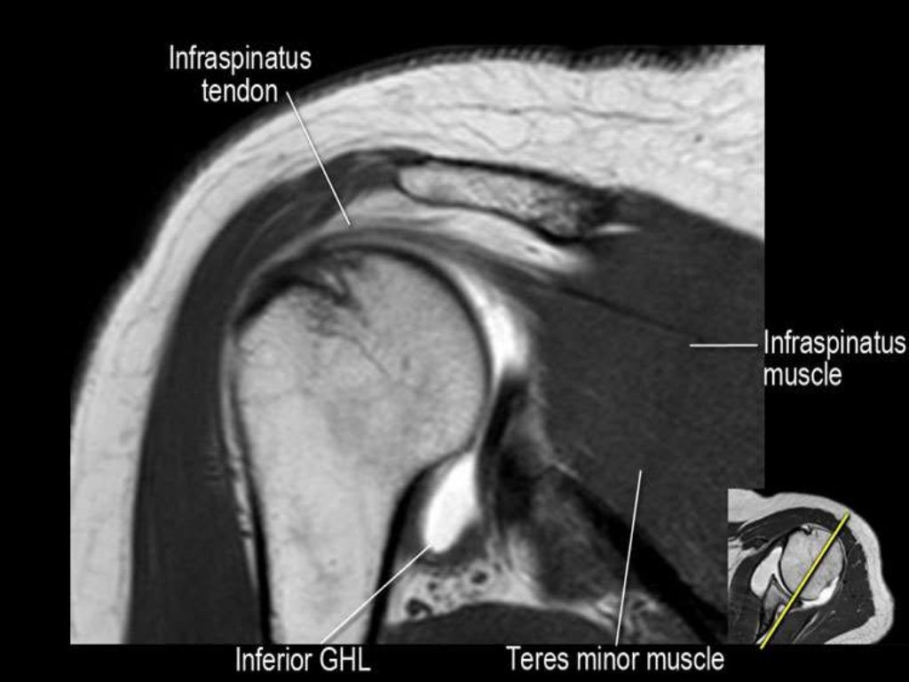 MRI of Shoulder anatomy