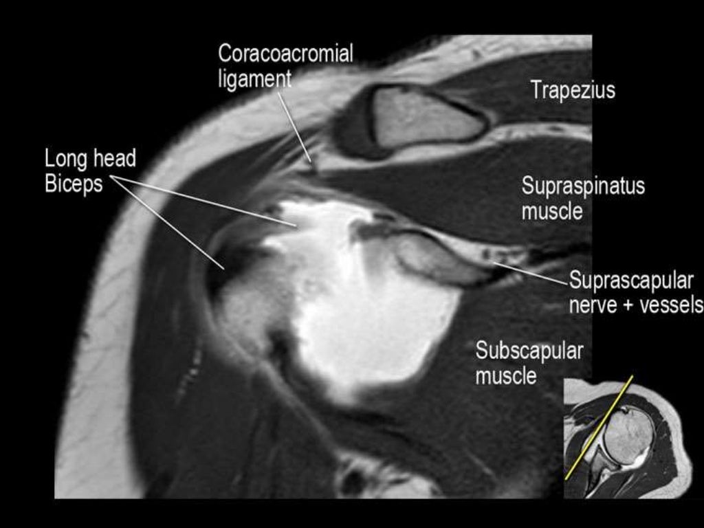 Mri Anatomy Of Shoulder at Leonard Kaminski blog