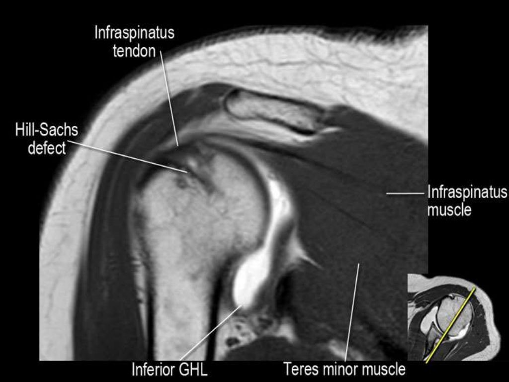Mri Anatomy Of Shoulder at Leonard Kaminski blog