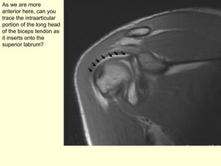shoulder_anatomy_166103_284_41995_v1.ppt