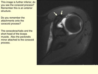shoulder_anatomy_166103_284_41995_v1.ppt
