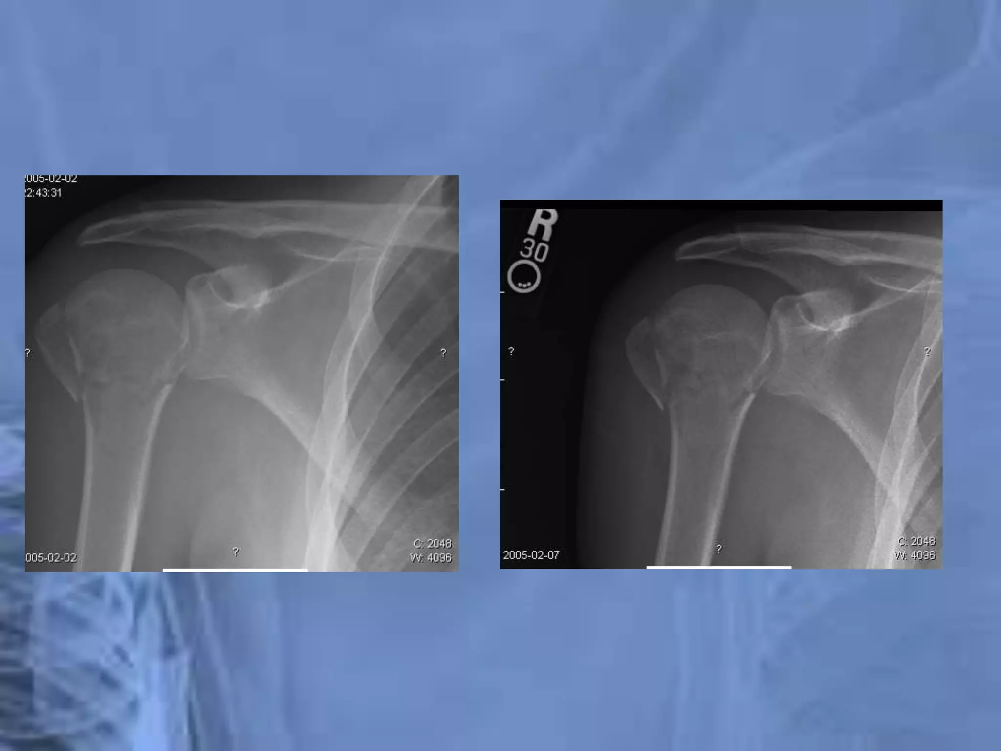 Shoulder anatomy & examination-2.pptx