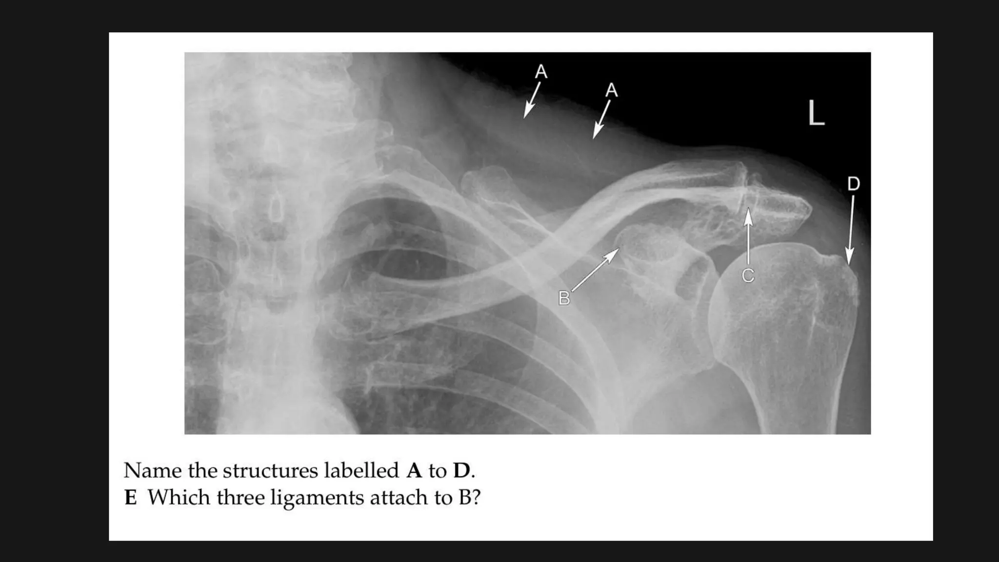 Radiological anatomy of SHOULDER joints | PPT