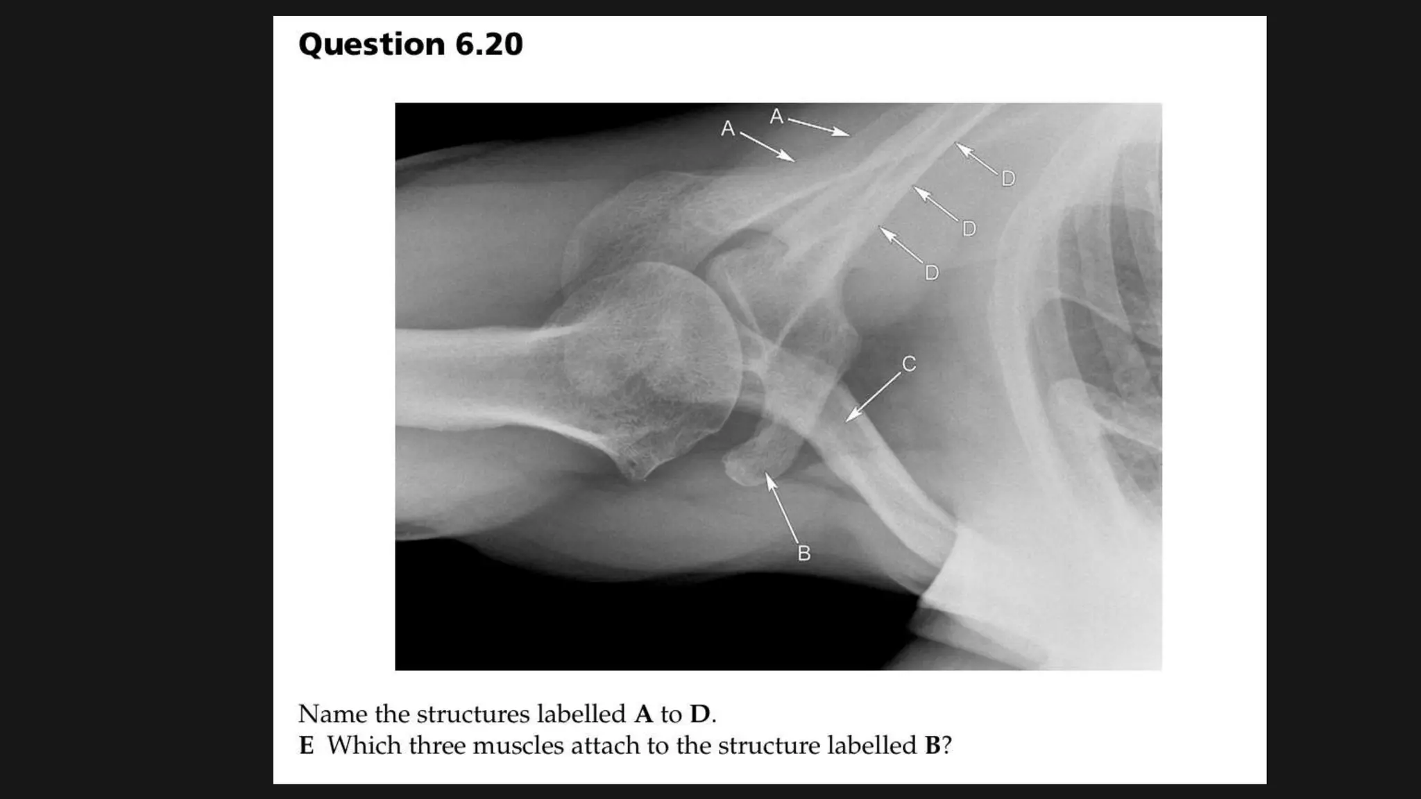 Radiological anatomy of SHOULDER joints | PPT