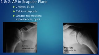 Shoulder Arthritis | Shoulder Instability | South Windsor, Rocky Hill ...