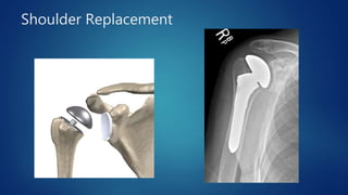 Shoulder Arthritis | Shoulder Instability | South Windsor, Rocky Hill ...