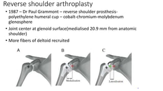 shoulder arthroplasty.pptx