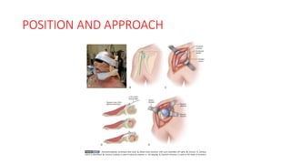 TOTAL AND REVERSE SHOULDER ARTHROPLASTIES | PPTX