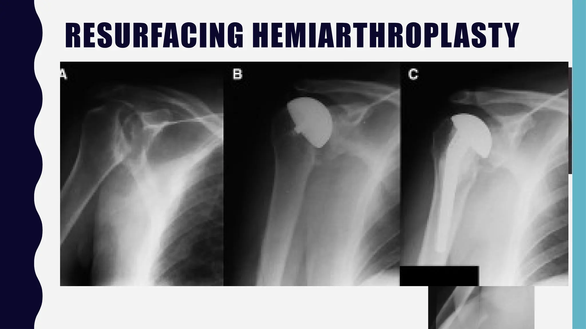 Shoulder Arthroplasty - A comprehensive review | PPTX