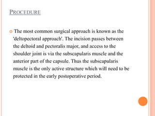 Shoulder arthroplasty & Physiotherapy | PPTX