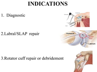 Shoulder arthroscopy | PPTX